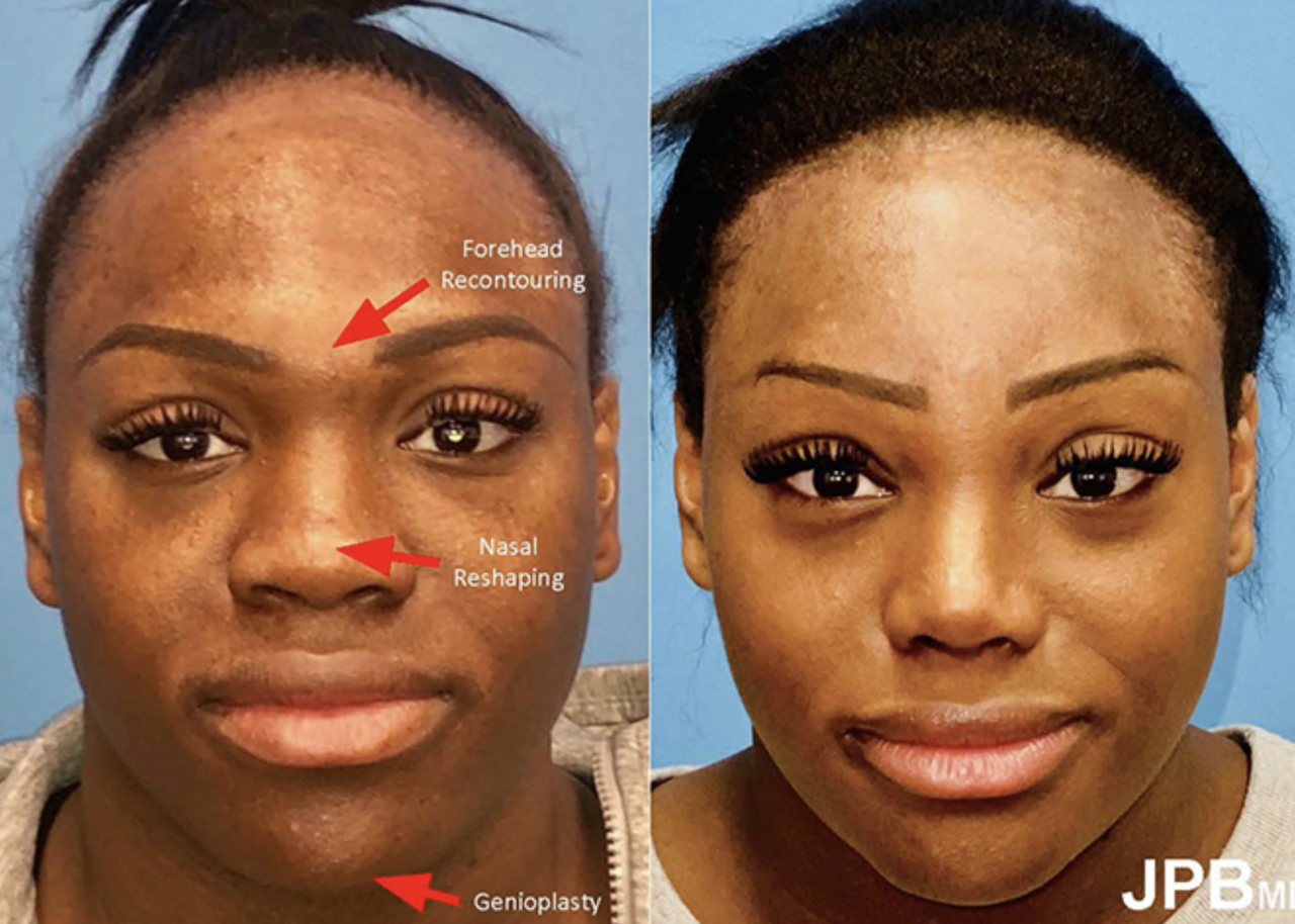 Before & After Facial Feminization Surgery | James P. Bradley, MD