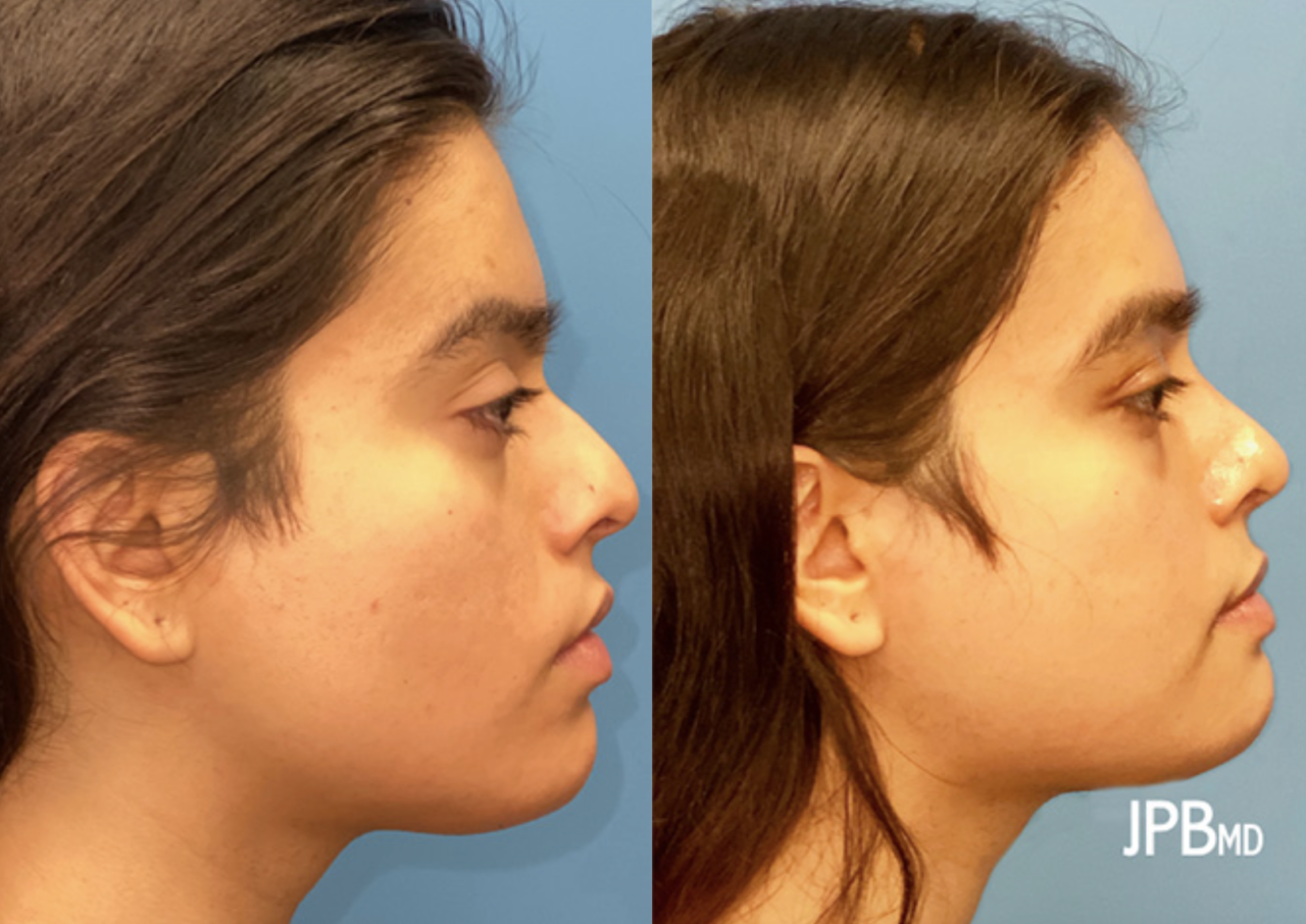 Before & After Facial Feminization Surgery | James P. Bradley, MD