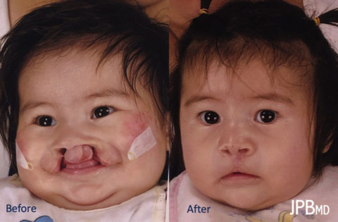 Cleft Rhinoplasty NYC | Nose Surgery | James P. Bradley, MD
