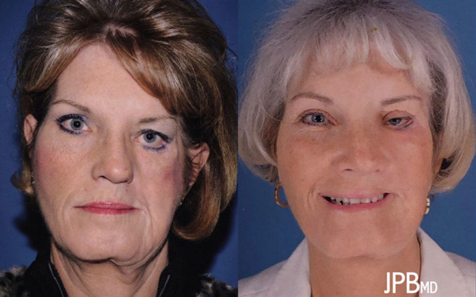 Hemifacial Microsomia Surgery in NYC | James P. Bradley, MD