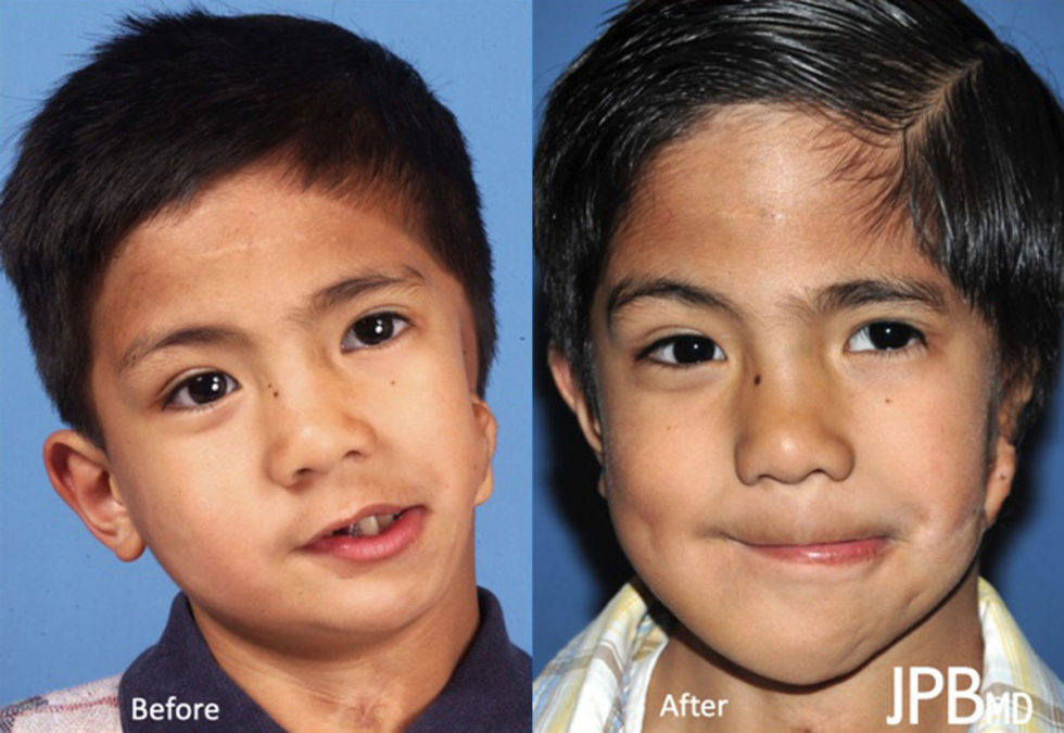 Hemifacial Microsomia Surgery in NYC | James P. Bradley, MD